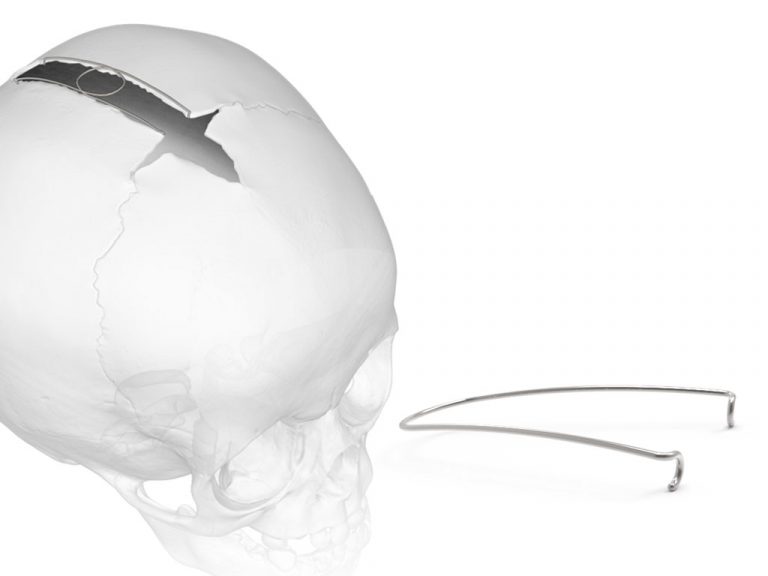 SmartFlex Pediatric Cranial Expander | Acumed