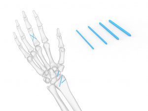 Inion FreedomPin | Acumed