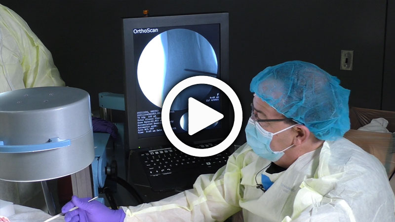 Repairing Syndesmotic Disruption with the Acumed Ankle Syndesmosis ...