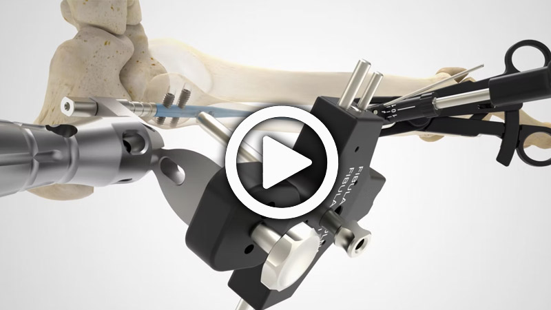 Fibula Nail 2 Surgical Technique Overview Animation | Acumed