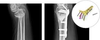 Acu-Loc 1 Million | Acumed