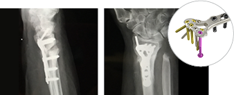 Acu-Loc 1 Million | Acumed