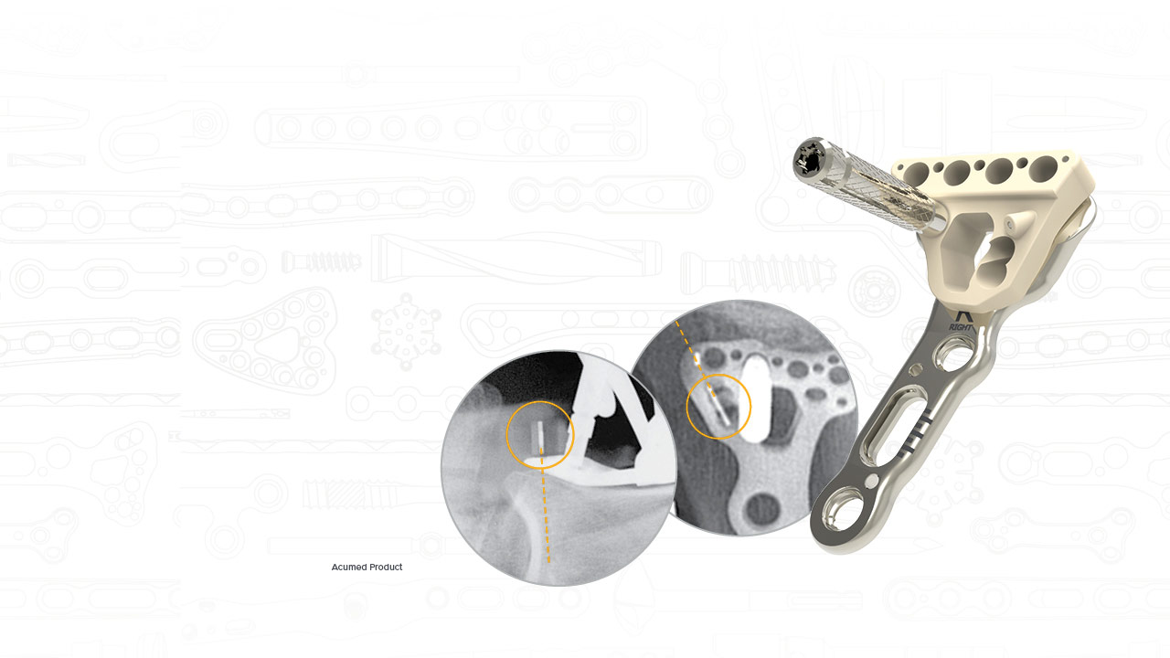 Acu-Loc 1 Million | Acumed