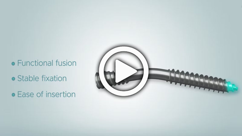 ArcPhix System Overview | Acumed