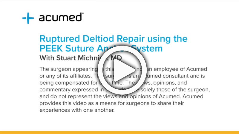 Ruptured Deltoid Repair Using the PEEK Suture Anchor System with Stuart ...
