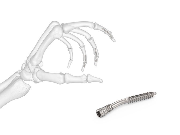 ArcPhix Functional Flexion Compression Screw System | Acumed