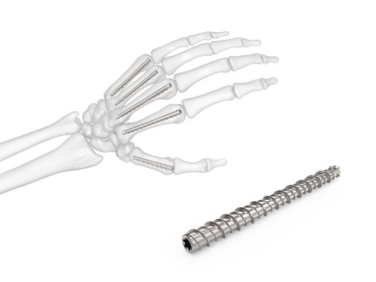 INnate Intramedullary Threaded Nail System | Acumed