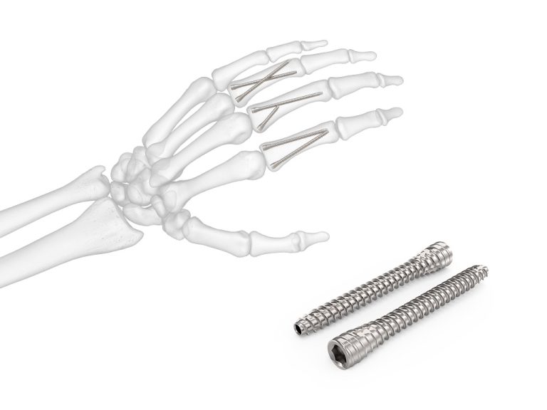 InFrame Intramedullary Micro Nail System | Acumed