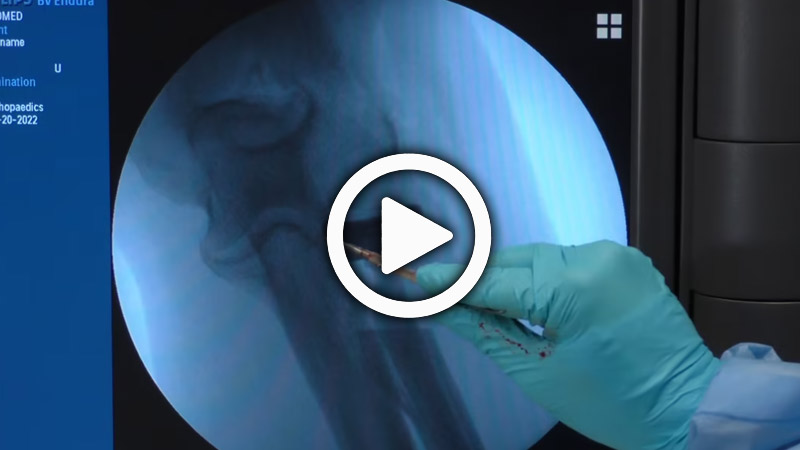 Radial Head Fracture Replacement Using The Long Stem Acumed Anatomic Radial Head Solutions 2