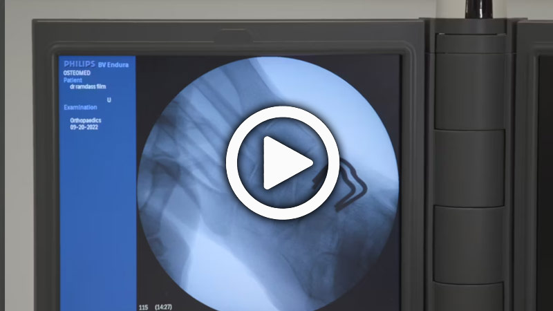 Osteomed InstaFix Shape Memory Fixation System for Talonavicular Joint ...