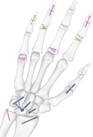 Acumed | Surgical Orthopedic Fracture Fixation Solutions