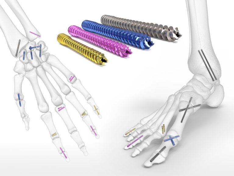 Acutrak 3 Headless Compression Screw System | Acumed