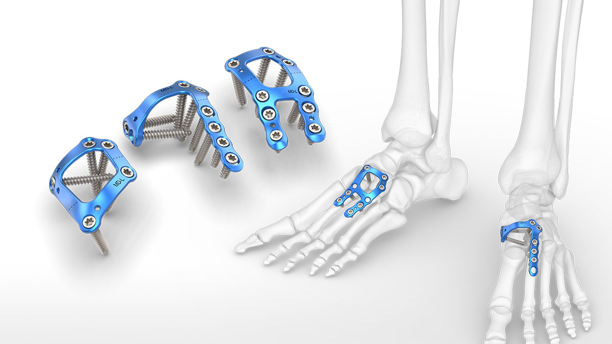 Surgical Arm Plates