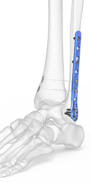 Acumed | Surgical Orthopedic Fracture Fixation Solutions